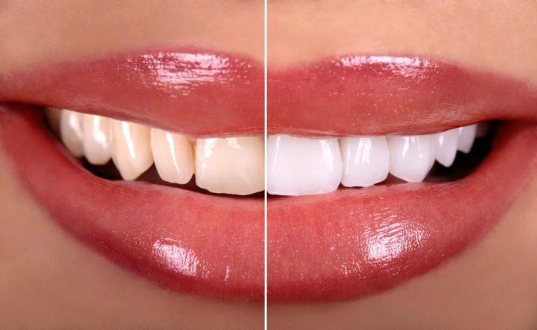 Manage Tooth Sensitivity After Whitening The Glen Dental